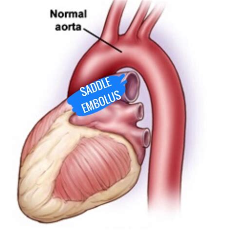 Saddle Pulmonary Embolism Diagram