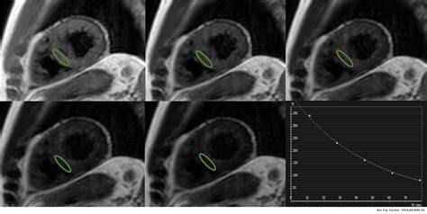 Myocardial Mapping With Cardiac Magnetic Resonance The Diagnostic Value Of Novel Sequences