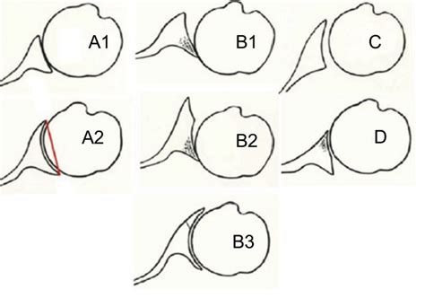 Uw Shoulder And Elbow Academy Is Correction Of Arthritic Glenoid Retroversion Necessary In