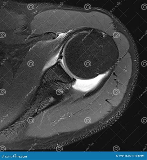 Arthrogram Mri With Contrast Stock Image Image Of Series Joint