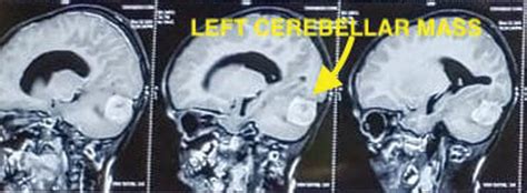 T1 Sagittal Magnetic Resonance Imaging Mri Scan Showing Left
