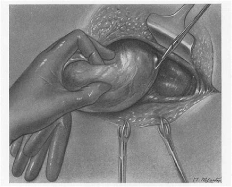 An Illustration Of The Perineal Dissection In Rectal Excision For Download Scientific