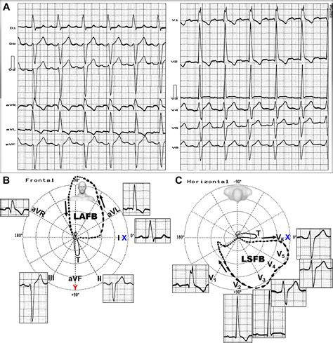 Left Septal Fascicular Block Evidence Causes And Diagnostic Criteria Heart Rhythm