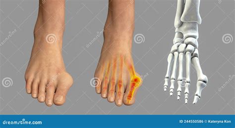 Hallux Valgus Disease Stages Cartoon Vector 190300007