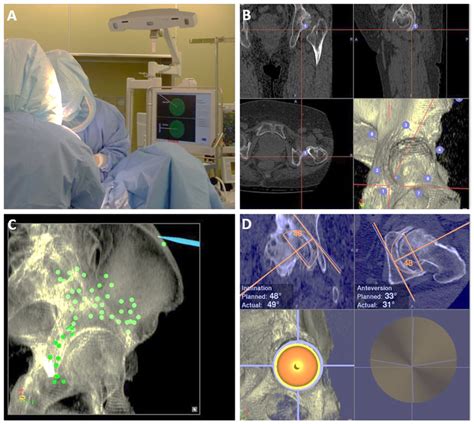 Intraoperative Picture Of Ct Navi A An Overall Picture Of The Download Scientific Diagram