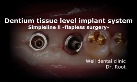 Dentium tissue level implant system - Simpleline ll (flapless surgery)