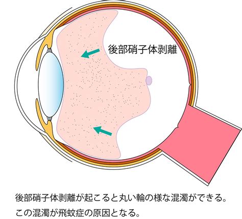 飛蚊症の原因と手術治療｜茨城県水戸市の小沢眼科内科病院