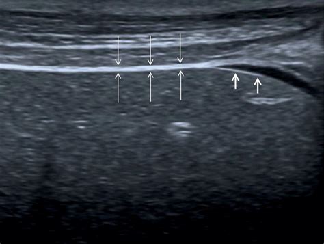 Normal Liver Anatomy Radiology Key