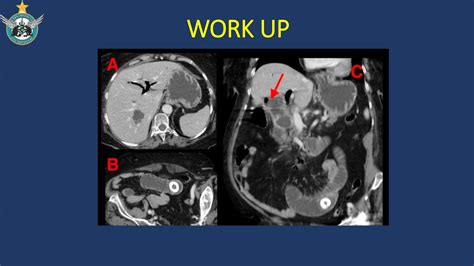 Management Of Patients With Gallstone Ileus Pptx
