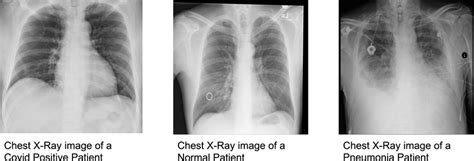 Sample Chest X Ray Images From The Dataset Download Scientific Diagram