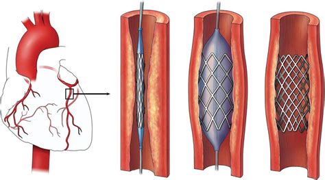 Effect Of Proton Pump Inhibitors On Anti Platelet Therapy Post Pci Hubpages