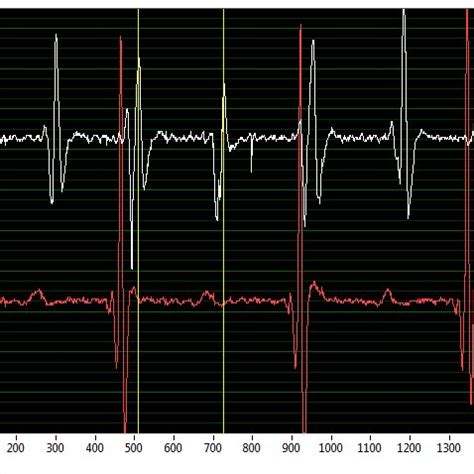 Example Of Right Atrial Flutter With 2 1 Atrioventricular Conduction Download Scientific