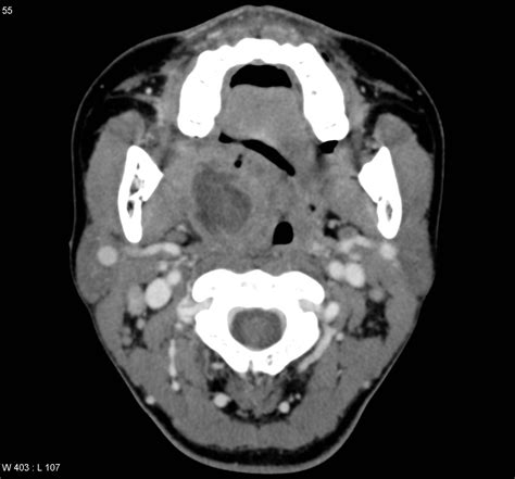 Tonsillar Abscess Image