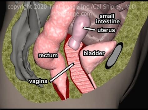 Bladder Prolapse Repair