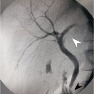 Transcystic Cholangiogram With Good Passage Of The Contrast To The Download Scientific Diagram
