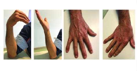 Post Operative Radiographs Showing Anatomic Reduction Of The Scaphoid
