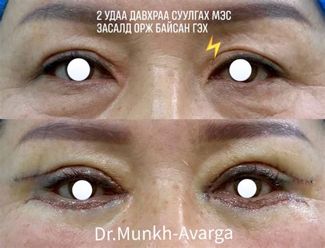 Та бүхэндээ энэ өдрийн мэнд хүргэе Давтан зовхины мэс засалд орж засуулах гэж байгаа хүмүүст