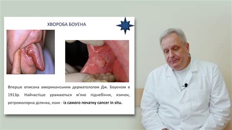 Передракові захворювання губи та слизової порожнини рота Youtube