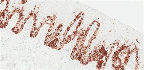 What Is Melan A Mypathologyreport