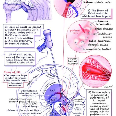 Strip Craniectomy For Sagittal Craniosynostosis Download Scientific