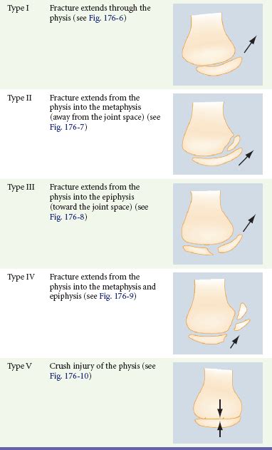 Salter Harris Fracture Classification Perycu