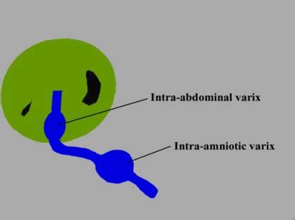 Umbilical Vein Varix