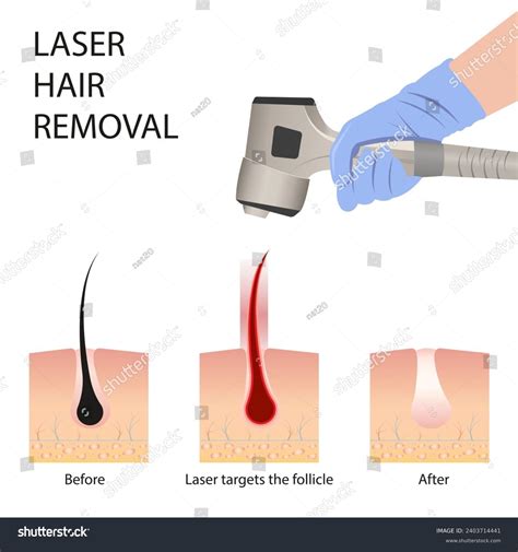 Laser Hair Removal Skin Layer Follicle Stock Vector Royalty Free