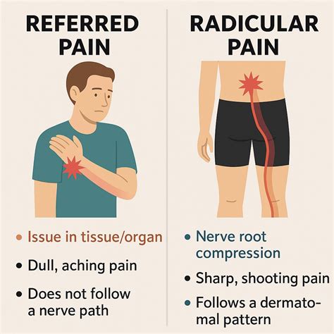 🎯 Referred Pain Vs Radicular Pain Whats The Difference Hazem Tarek