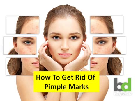 How To Get Rid Of Pimple Marks TOP DIY
