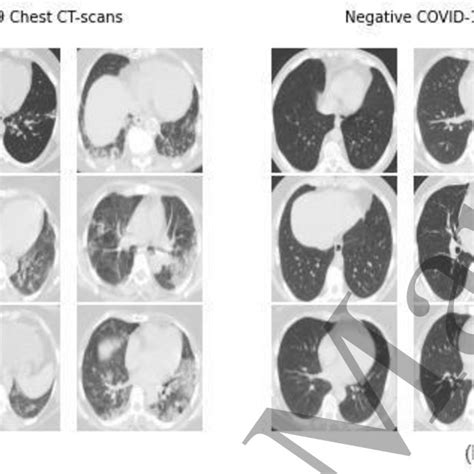 Sars Cov 2 Ct Scan Dataset Sample Images A Covid 19 Ve Patients
