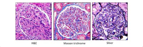 Glomeruli With Global Endocapillary Hypercellularity With Leukocytes Download Scientific