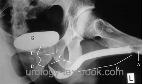 Retrograde Urethrography Technique And Normal Findings