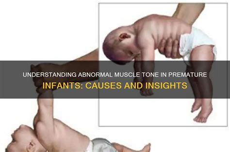 Understanding Abnormal Muscle Tone In Premature Infants Causes And