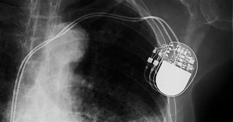 A New Pacemaker Hack Puts Malware Directly On The Device WIRED