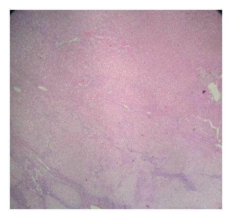 A Macroregenerative Nodules In Explants Liver B Photomicrograph Download Scientific