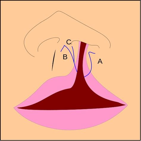 Cleft Lip And Palate Surgical Repair Geeky Medics