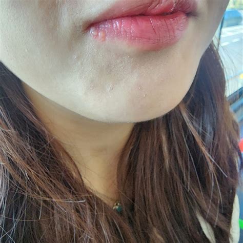 입술에 뭐가 생겼는데 이게 뭔가요 지식in