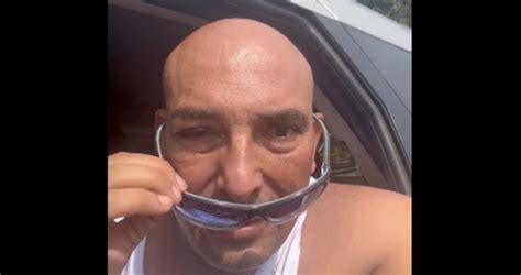 Omar Angulo Reaparece Con Un Ojo Morado Diario El Mundo