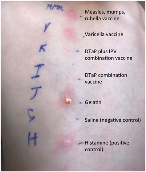 Immune‐mediated Adverse Reactions To Vaccines Stone 2019 British