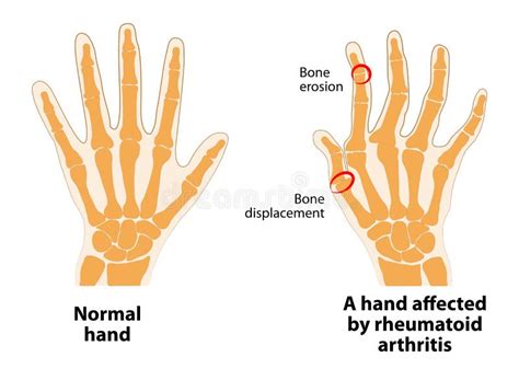 Osteoarthritis Vs Rheumatoid Arthritis Hands Arthritis Types And