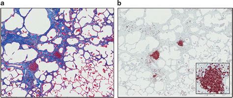 Accumulation Of Cd20 B Cell Aggregates In The Lung Tissue Of Ipf Download Scientific Diagram