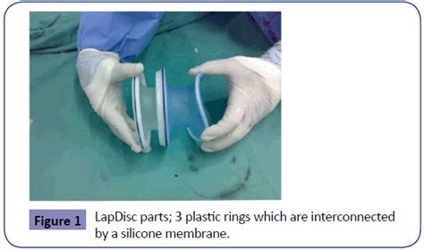 The Surgical Technique Of Hand Assisted Laparoscopic Sigmoid Colectomy