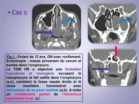 Ppt Polype Antro Choanal De Killian Apport De La Tdm Haute Resolution