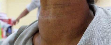 Multinodular Goiter Thyroid In Women