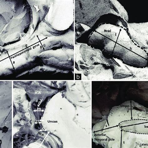 Techniques Of Measurement Of Medial Temporal Lobe Structures A Uncus