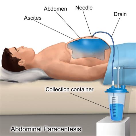 danielle tann on linkedin best coding tips for paracentesis cpt code
