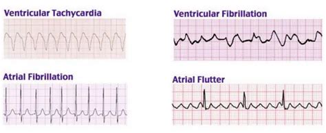 Basics Of Ecg Step By Step