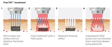 Ablative Laser Reskin Laser Clinic
