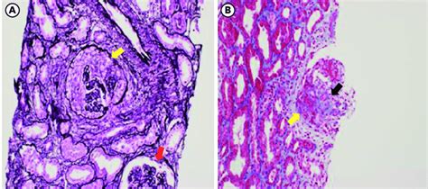 Light Microscopic Findings A A Glomerulus Shows A Global Cellular