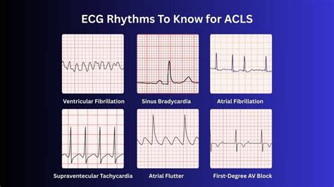 Ecg Rhythms Recognition And Interpretation For Acls